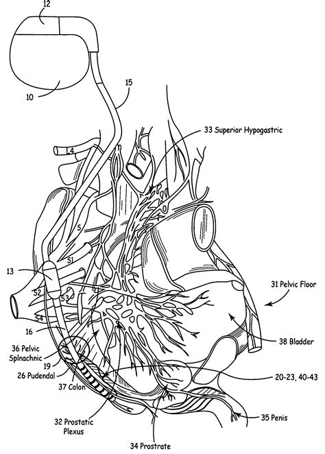 Lead Placement Patented Technology Retrieval Search Results Eureka Patsnap