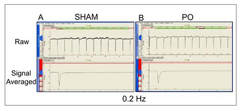 Analysis Of Cardiac Contractile Dysfunction And Ca2 Transients In