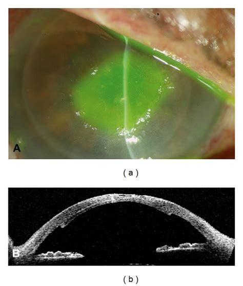 Day 1 Postoperatively A Slit Lamp Photography Showing Epithelial