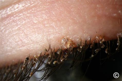 Crabs Disease