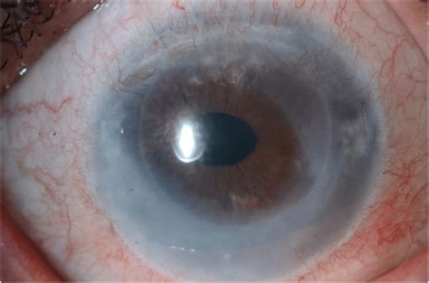 Diffuse Corneal Oedema In A Grafted Eye Download Scientific Diagram