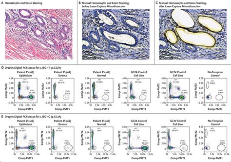 Confirmation Of Activating Somatic Kras Mutations In The Glandular