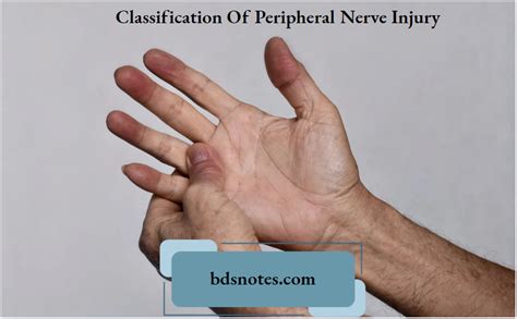 Classification Of Peripheral Nerve Injury Bds Notes