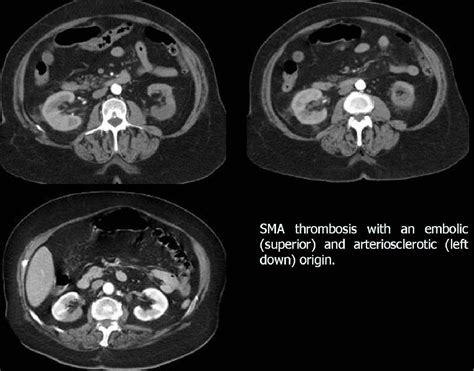 Figure 1 From Root Of Mesentery Anatomic And Pathologic Review Semantic Scholar