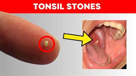 Signs You Have Tonsil Stones And How To Get Rid Of Them Youtube