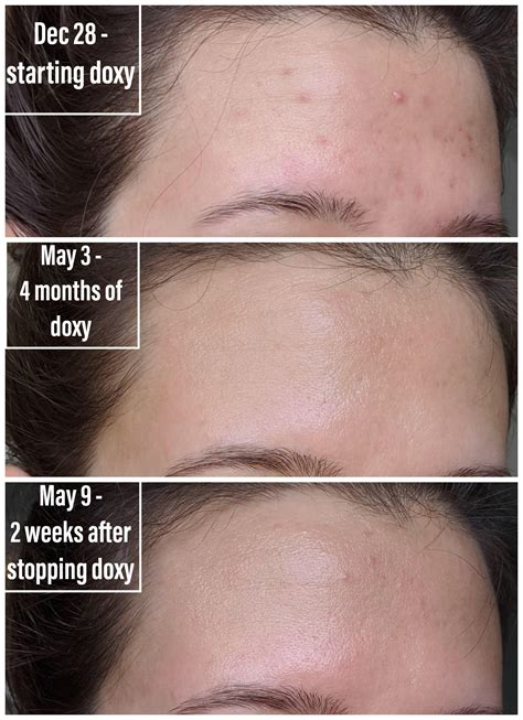 133 Best Doxycycline Images On Pholder Acne Skincare Addiction And Rosacea