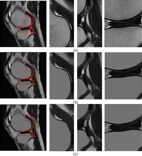 Figure 5 From Medical Image Segmentation Using Mean Shift Algorithm And