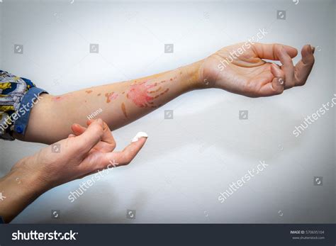 27 322 Treating A Burn Images Stock Photos Vectors Shutterstock