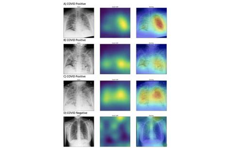This AI Algorithm Could Detect COVID In Chest X Rays Medical Design And Outsourcing