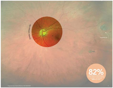 Optos Vs Fundus Camera At Hazel Anderson Blog