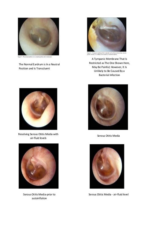 Perforated Eardrum Virus At Christine Mayer Blog