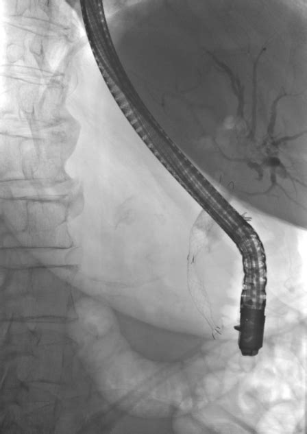 Strategy For Ercp Stenting In Cholangiocarcinoma