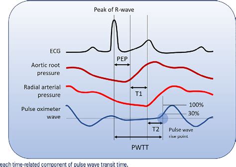 Figure 1 From Estimated Continuous Cardiac Output Based On Pulse Wave