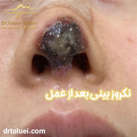 سیاه شدن بافت و نکروز بینی اطلاعات جامع علت و درمان