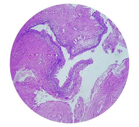 Premium Photo Histology Of Urachal Cyst Photomicrograph Of