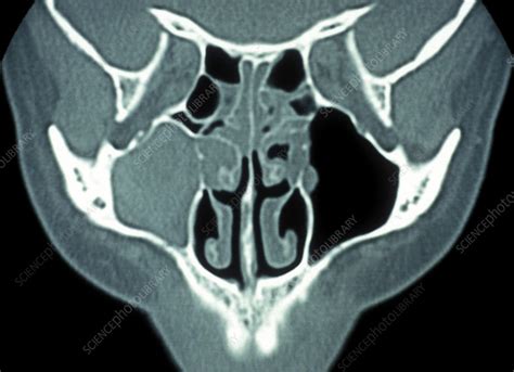 Maxillary Hyperostosis Radiology At Melody Hanks Blog