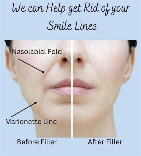 Is Nasolabial Filler Dangerous