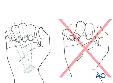 Compression Plating For Oblique Fracture Of The Diaphysis