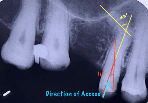 Endodontics Curvedcanals Dentistry Indrani Roy