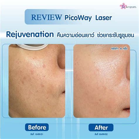 Pico Laser คืออะไร มีกี่แบบ ช่วยเรื่องอะไรบ้าง ทำที่ไหนดี