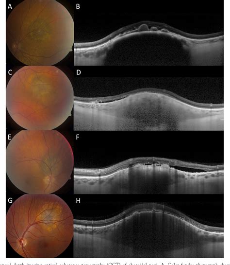 Nevus Depigmentosus Semantic Scholar