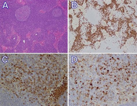Excisional Lymph Node Biopsy Shows Reactive Lymphoid Hyperplasia A Download Scientific