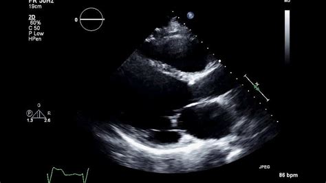 Ischemic Cardiomyopathy 2d Echocardiogram Youtube