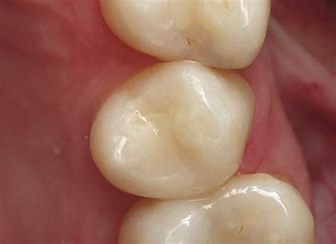 Triodent V3 Sectional Matrix System Clinical Research Dental