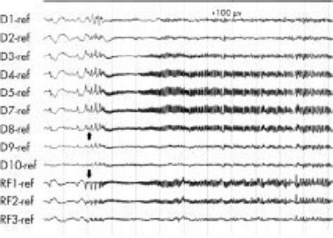 Selected EEG Recording From Another Patient Showing Reversal Of Download Scientific Diagram