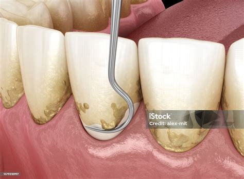 구강 위생 스케일링 및 루트 기획 인간의 치아 치료의 의학적으로 정확한 3d 그림 0명에 대한 스톡 사진 및 기타 이미지 Istock