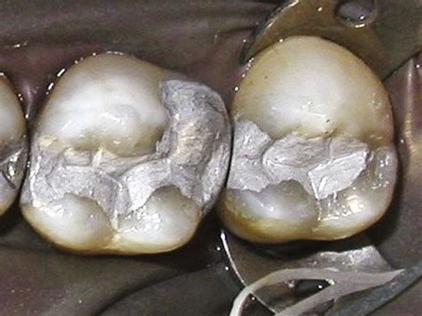 16 Complex Amalgam Restorations Pocket Dentistry
