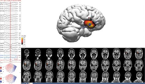 John Libbey Eurotext Epileptic Disorders Temporal” Intermittent Rhythmic Delta Activity