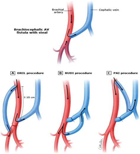 Recognizing Dialysis Access Steal Syndrome With Central Vein Stenosis