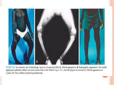 Angular Deformities Around The Knee Seminar Pptx