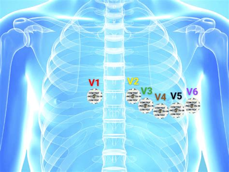 Ekg Anlegen So Kleben Sie Ekg Elektroden Richtig