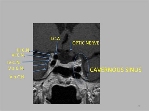 Cavernous Sinus Mri