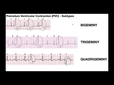 Premature Ventricular Contractions Bigeminy Premature Ventricular Contractions Bigeminy