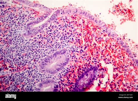 Histopathology Of Chronic Appendicitis Light Micrograph Photo Under Microscope Stock Photo Alamy