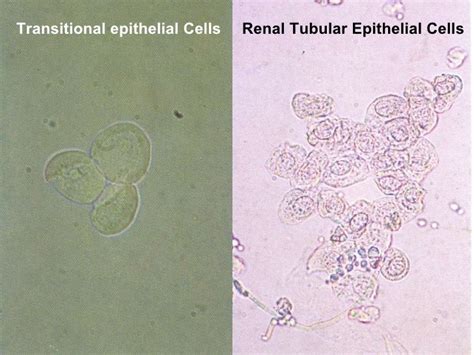 Caudate Transitional Epithelial Cells In Urine Sediment Fus Series Of