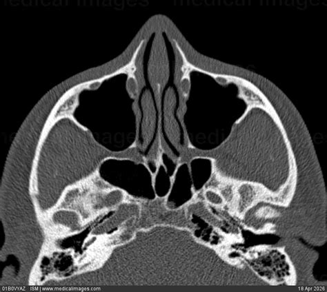 Stock Image Normal Maxillary Sinuses And Sphenoid Sinus Below The
