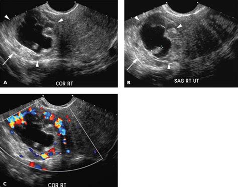 Ectopic Pregnancy Radiology Key