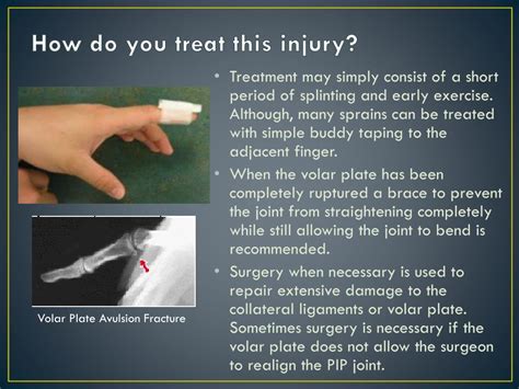 Ppt Finger Dislocation Of The Pip Joint And Volar Plate Powerpoint Presentation Id 2280979