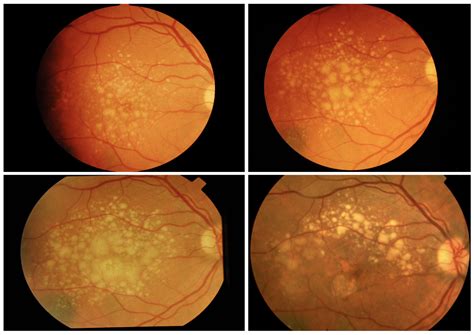 Understanding Age Related Macular Degeneration