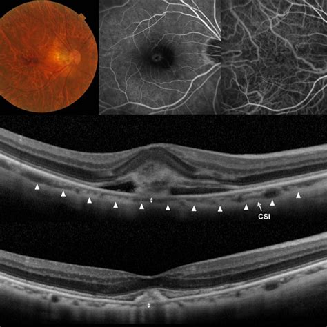 Myopic Choroidal Neovascularization Cnv Treated With Ranibizumab