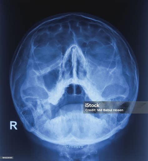 Pns Xray Om View Film Left Maxillary Sinusitis With Hypertrophied