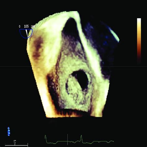 183 Secundum Atrial Septal Defect With Left To Right Shunt Dilated