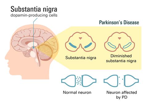 Parkinsons Disease Causes Symptoms Diagnosis Treatment