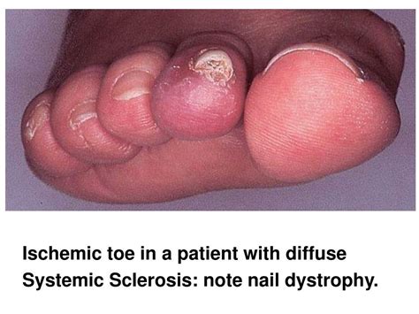 Ppt The Face In Diffuse Systemic Sclerosis Note The Radial Furrows