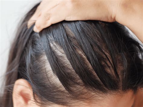 Hormonal Hair Loss In Women Aestha Clinic