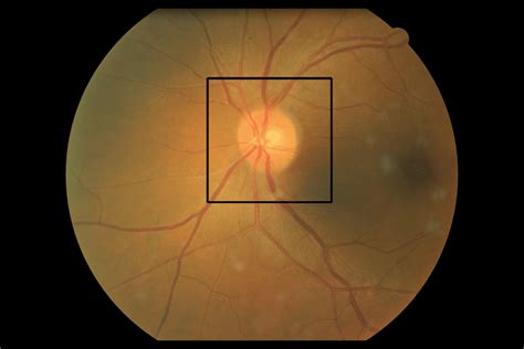 2 Coarse Localization Of Optic Disc In 1 A From Full 3504 × 2336